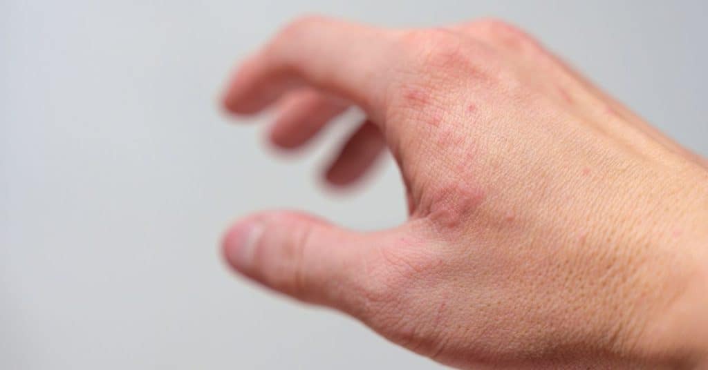 How to treat a concrete burn - craftingwithconcrete.com